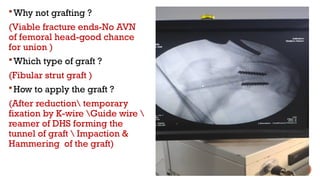 Fibular strut graft enhance neck femur union in.pptx