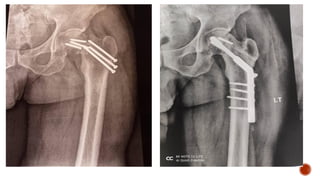 Fibular strut graft enhance neck femur union in.pptx