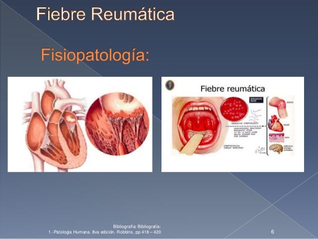 Fiebre reumatica