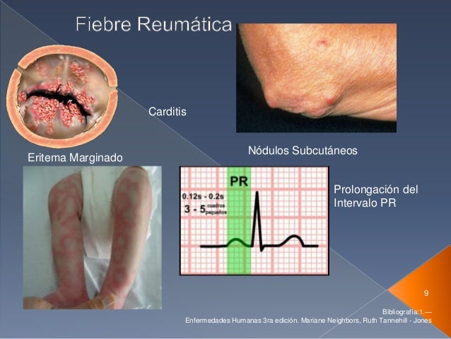 Fiebre reumatica