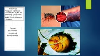 FIEBRE AGUDA en hospiatl nacinal univeistario.pptx