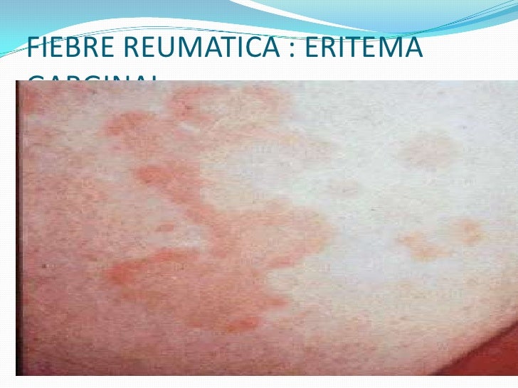 Fiebre reumatica