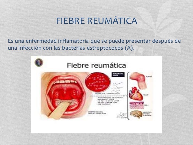 Fiebre reumatica