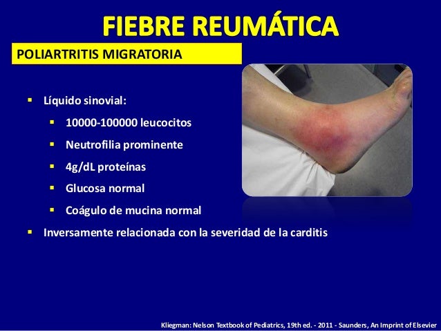 Fiebre reumatica