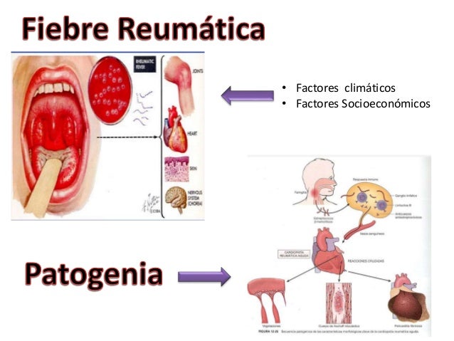Fiebre reumatica