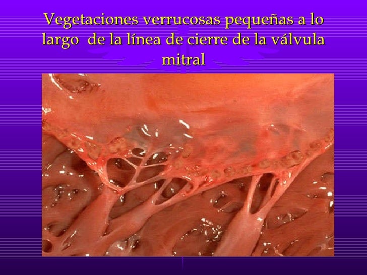 Fiebre reumática y cardiopatía reumatica