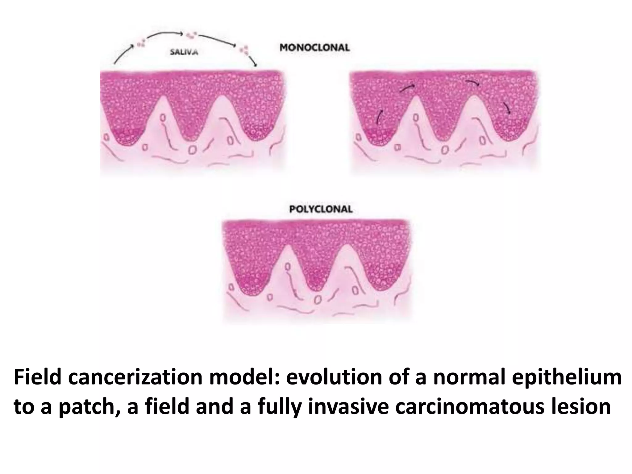 Field cancerization | PPTX