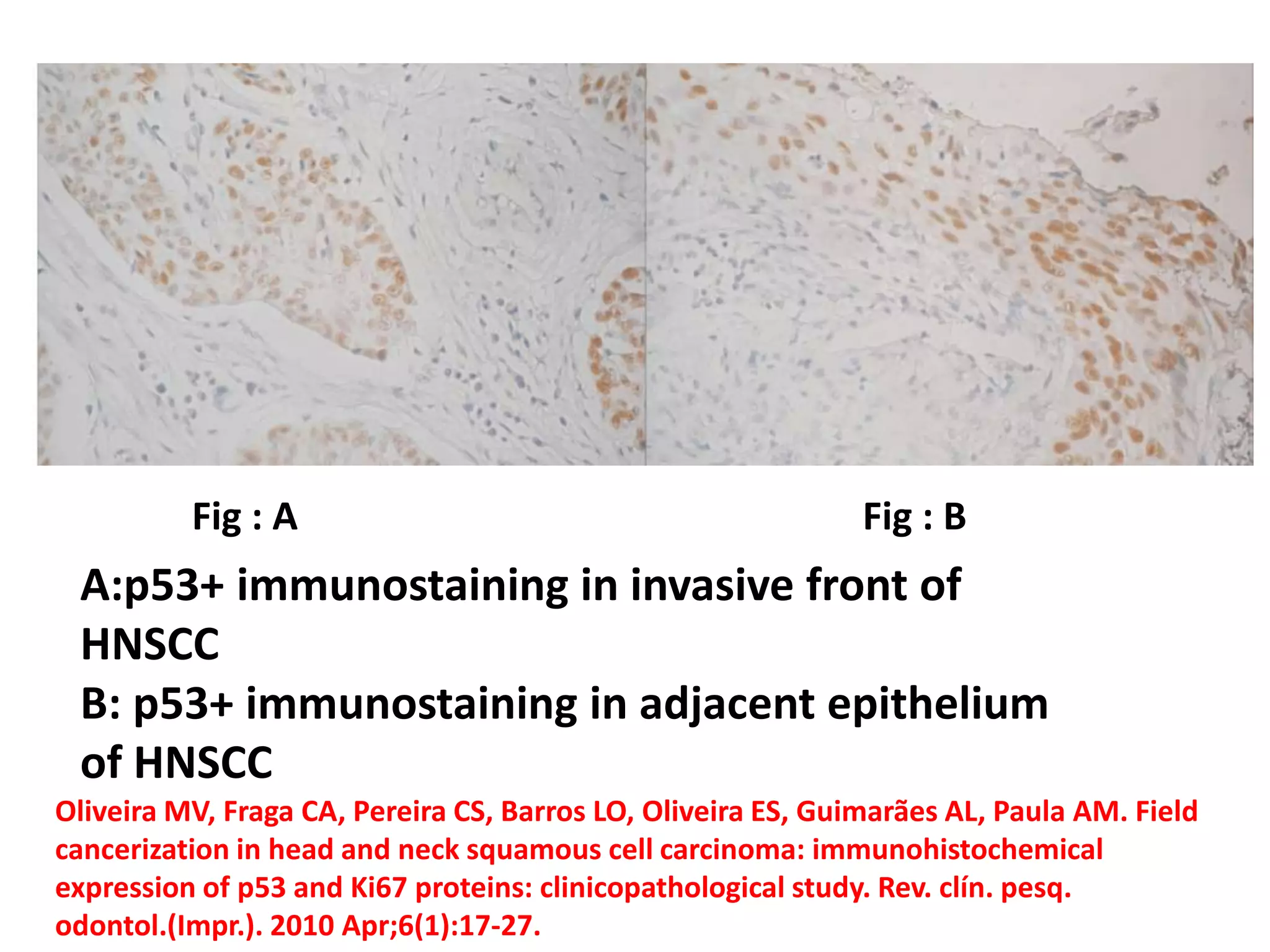 Field cancerization | PPTX