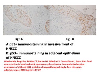 Field cancerization | PPTX