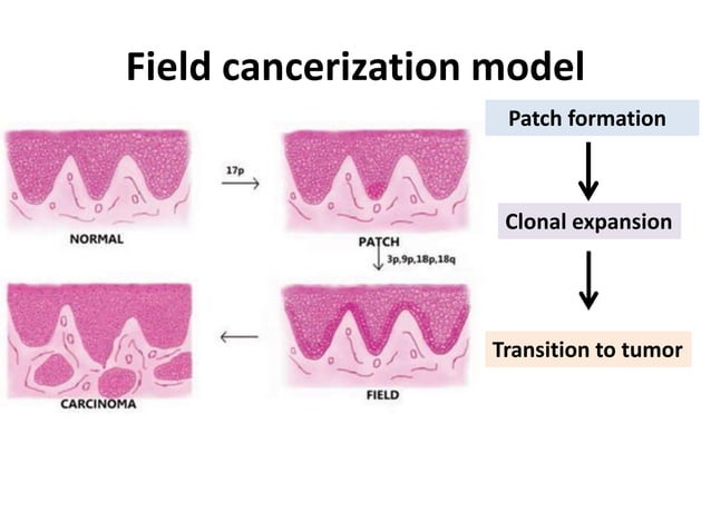 Field cancerization