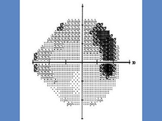 Comprehensive Overview of Visual Field Defects in Glaucoma Diagnosis ...