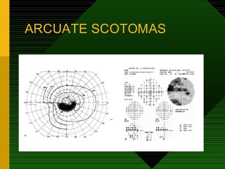 Fields glaucoma