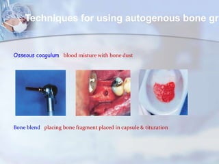 application of bone graft in dentistry | PPTX
