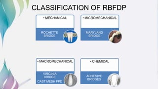 Fifteen year survival of all ceramic cantilever rbfdp | PPTX