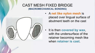 Fifteen year survival of all ceramic cantilever rbfdp | PPTX