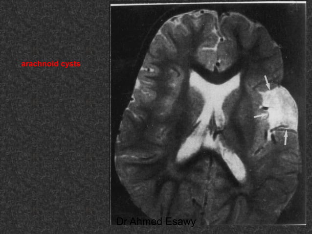Fifteen (50) intracranial cystic lesion Dr Ahmed Esawy CT MRI main | PPT