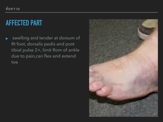 Fifth metatarsal bone fracture | PDF