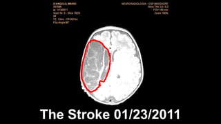 Fight the stroke @ tedglobal2013 | PPTX