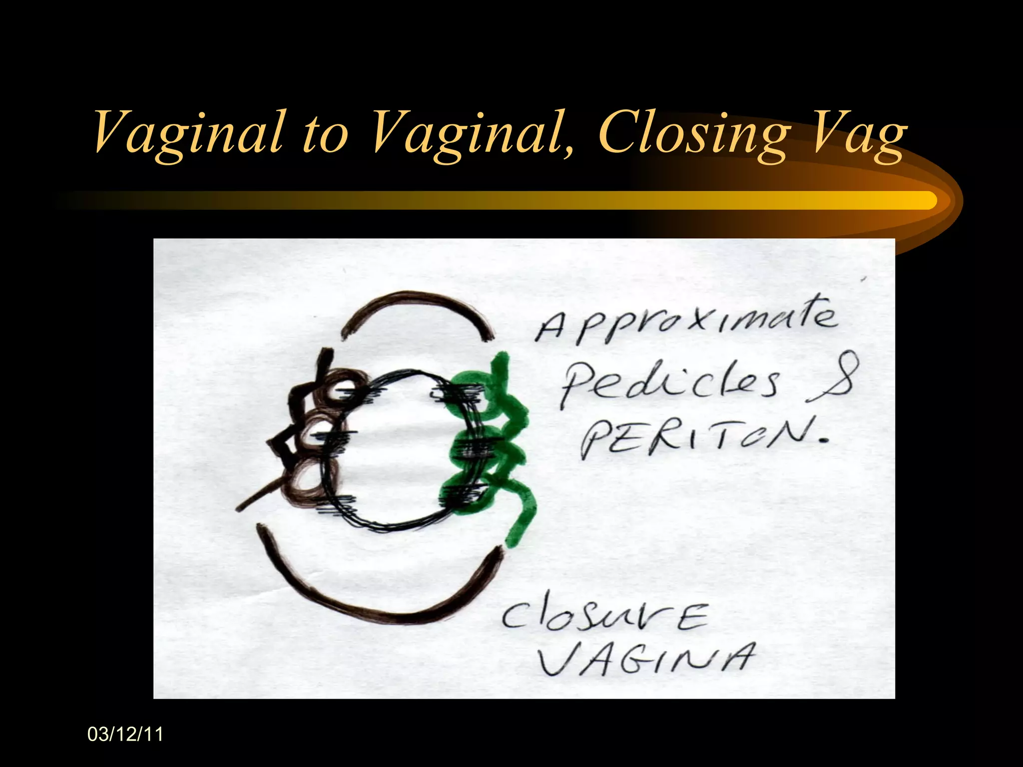 Vaginal Hysterectomy Safe Technique Ppt