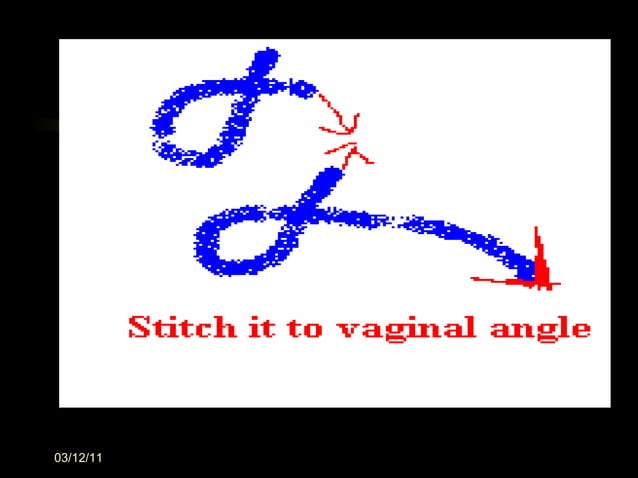 Vaginal Hysterectomy: Safe Technique | PPT