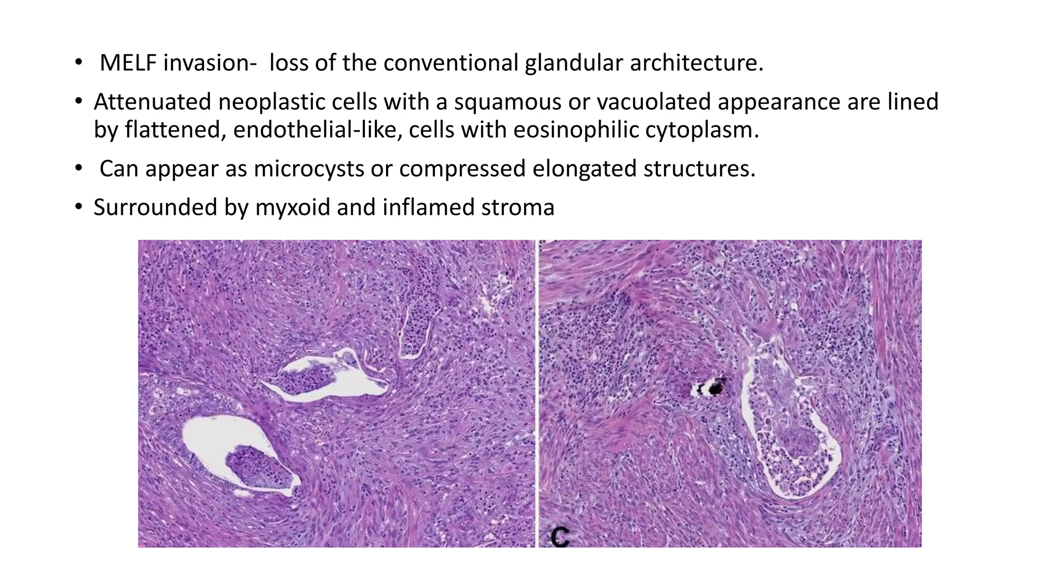 FIGO staging of endometrial cancer: 2023 | PDF
