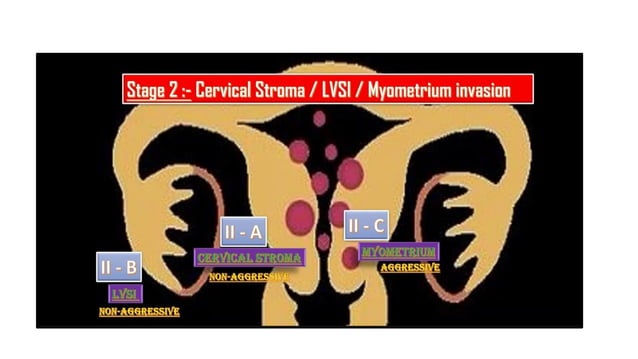Figo Staging Of Endometrial Cancer 2023 Ppt Free Download