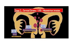 FIGO staging of endometrial cancer 2023.ppt