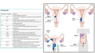 FIGO staging of endometrial cancer 2023.ppt