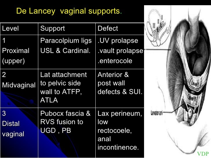 Figo vault prolapse - dr vivekpatkar