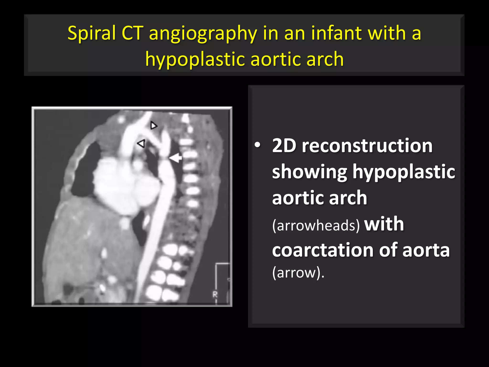 Figure 3 sign fleischner sign-fissure sign-headcheese sign-hilar ...