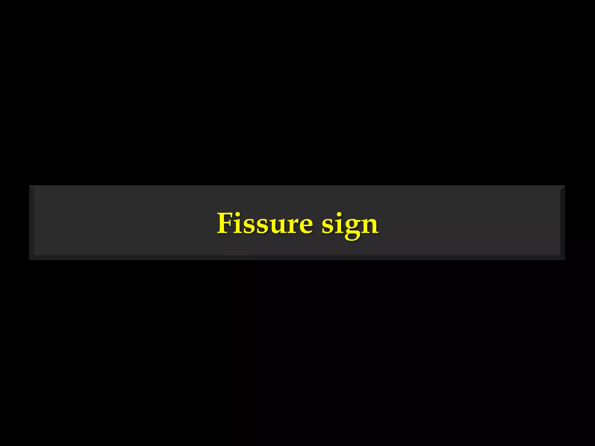 Figure 3 sign fleischner sign-fissure sign-headcheese sign-hilar ...