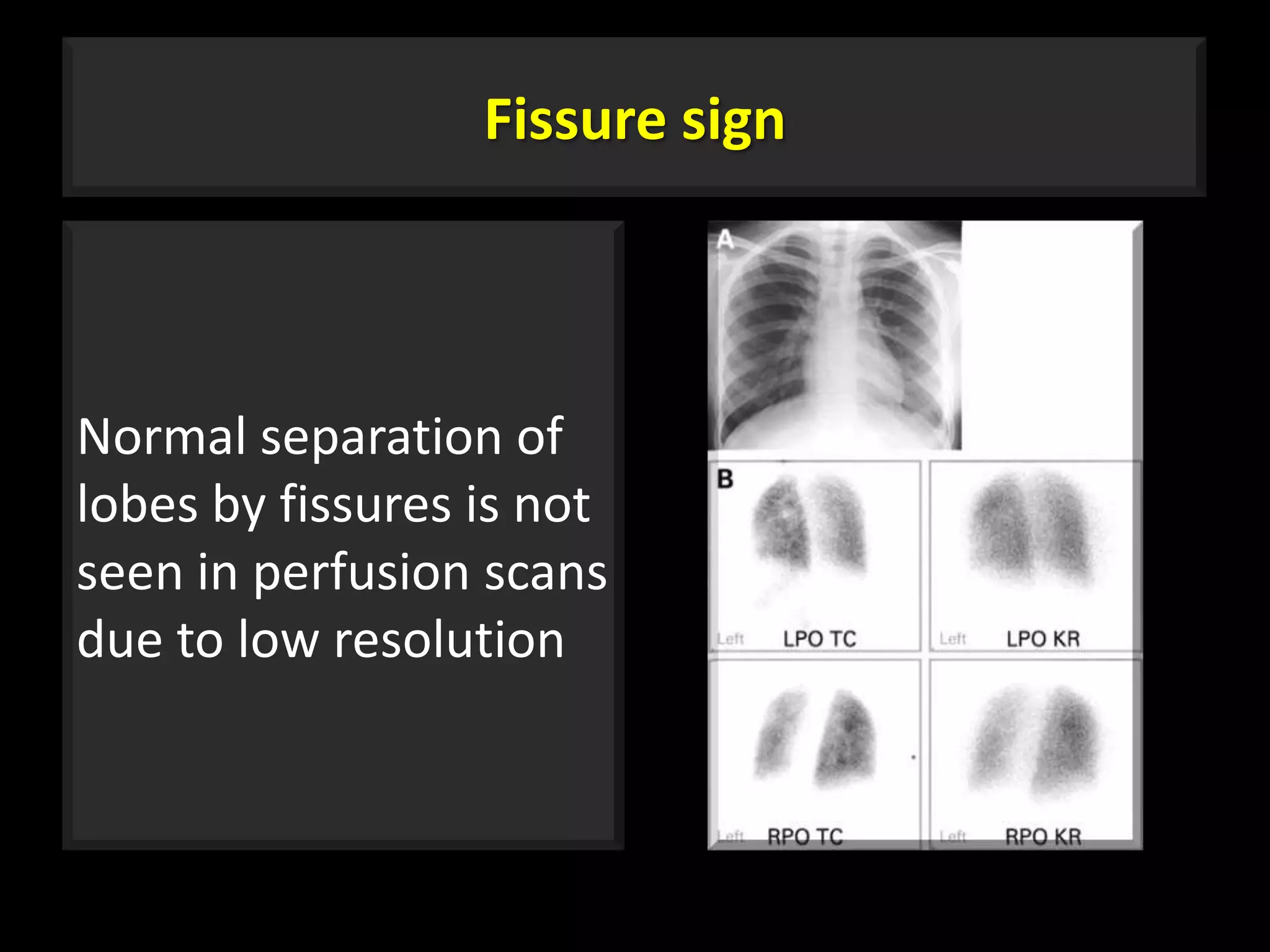 Figure 3 sign fleischner sign-fissure sign-headcheese sign-hilar ...