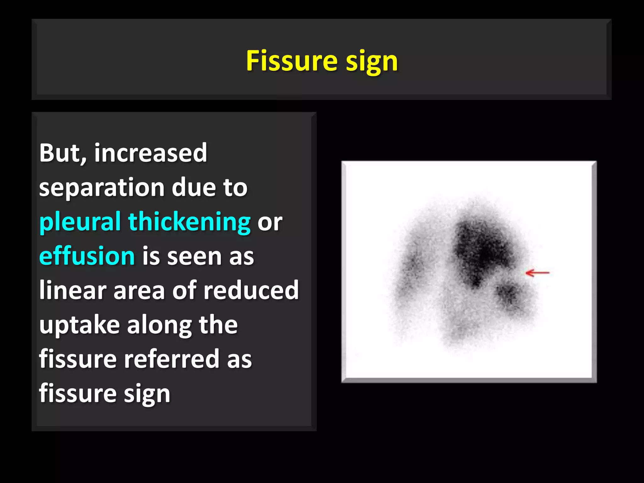 Figure 3 sign fleischner sign-fissure sign-headcheese sign-hilar ...
