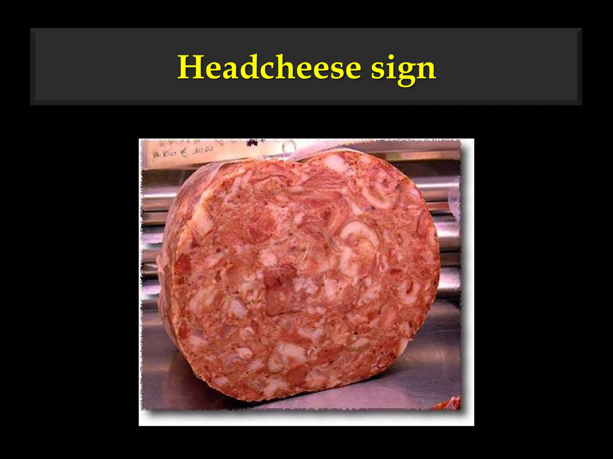 Figure 3 sign fleischner sign-fissure sign-headcheese sign-hilar ...