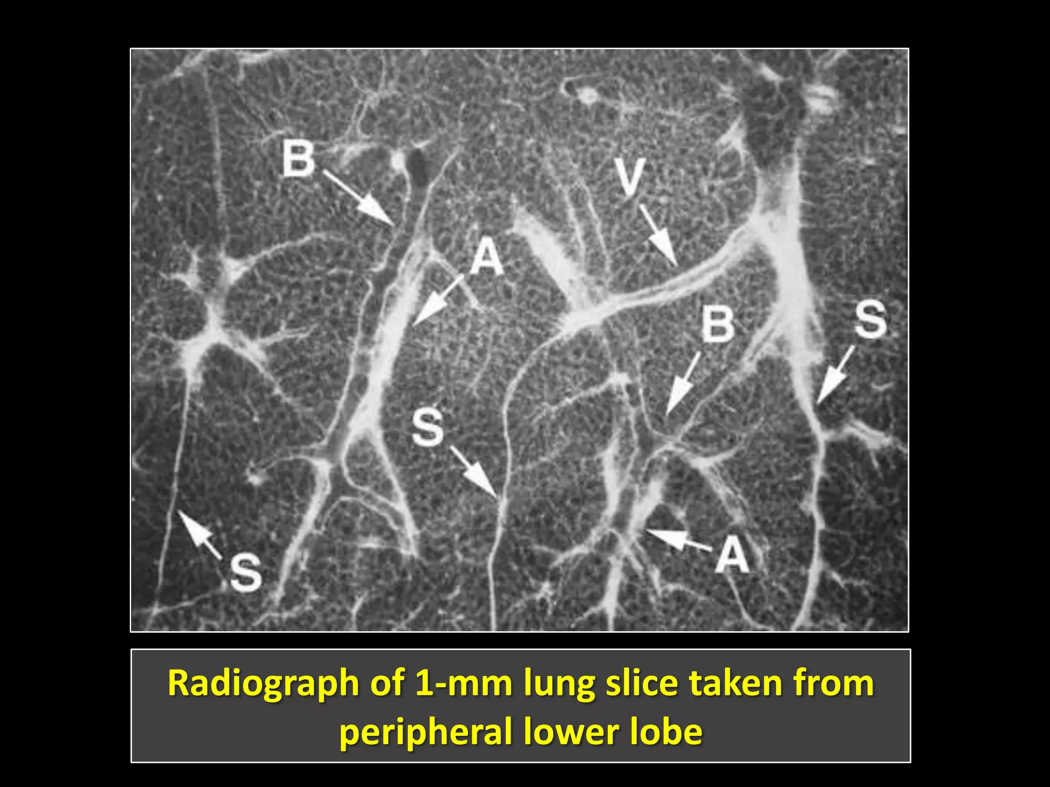 Figure 3 sign fleischner sign-fissure sign-headcheese sign-hilar ...