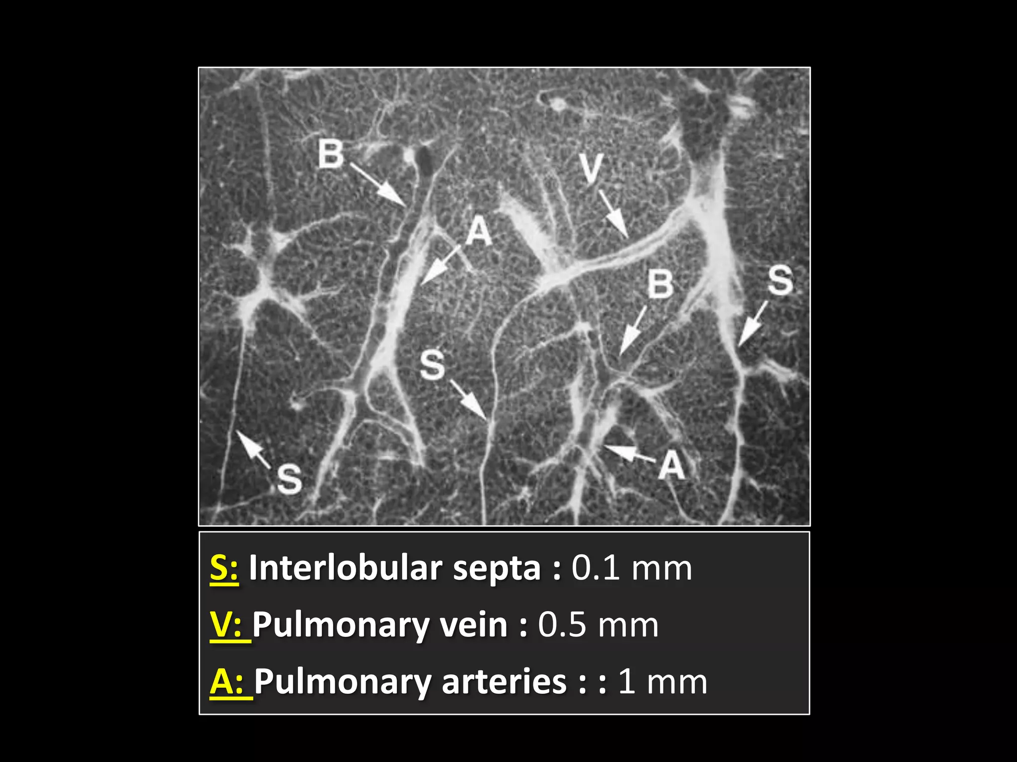 Figure 3 sign fleischner sign-fissure sign-headcheese sign-hilar ...