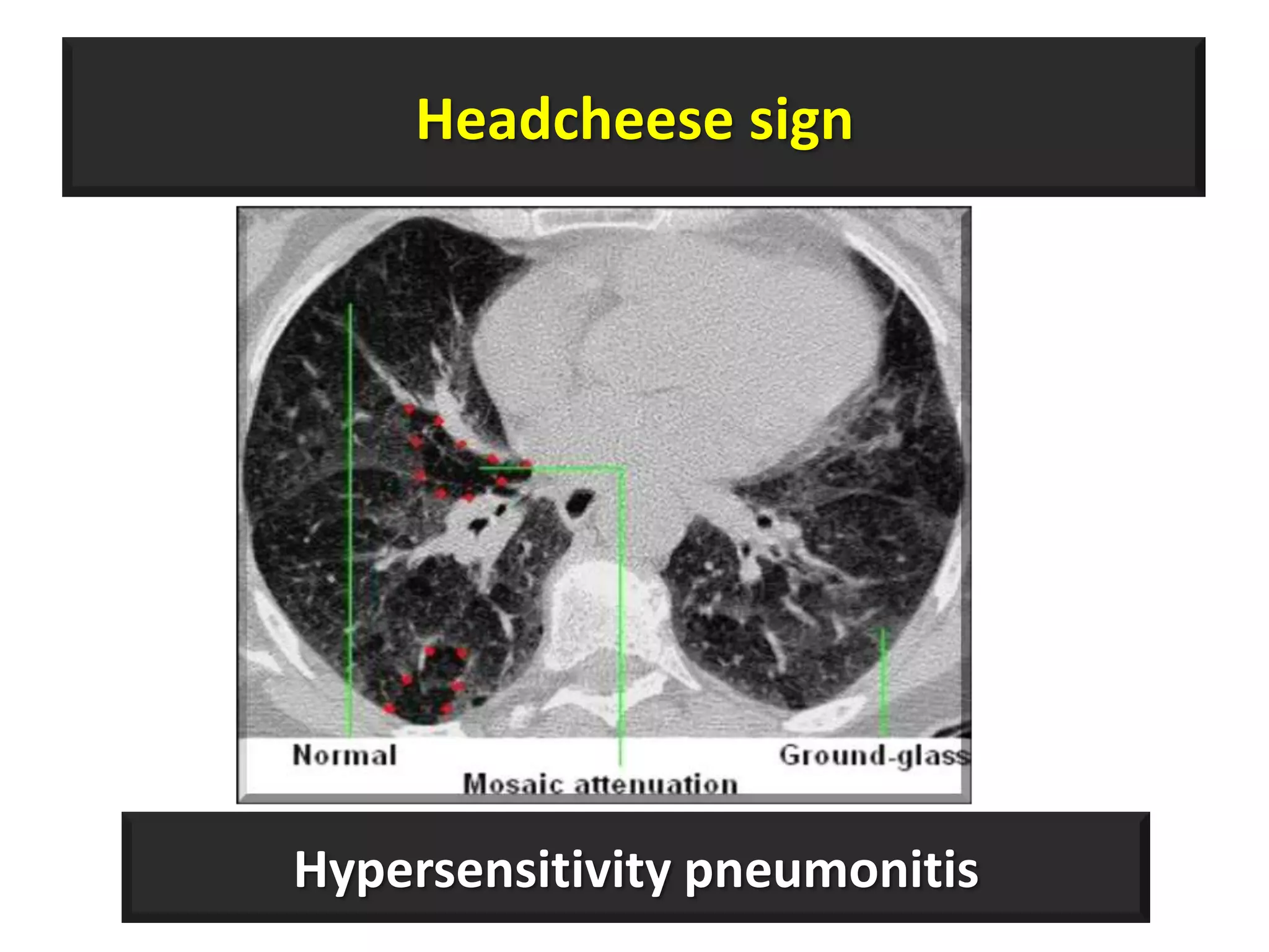 Figure 3 sign fleischner sign-fissure sign-headcheese sign-hilar ...