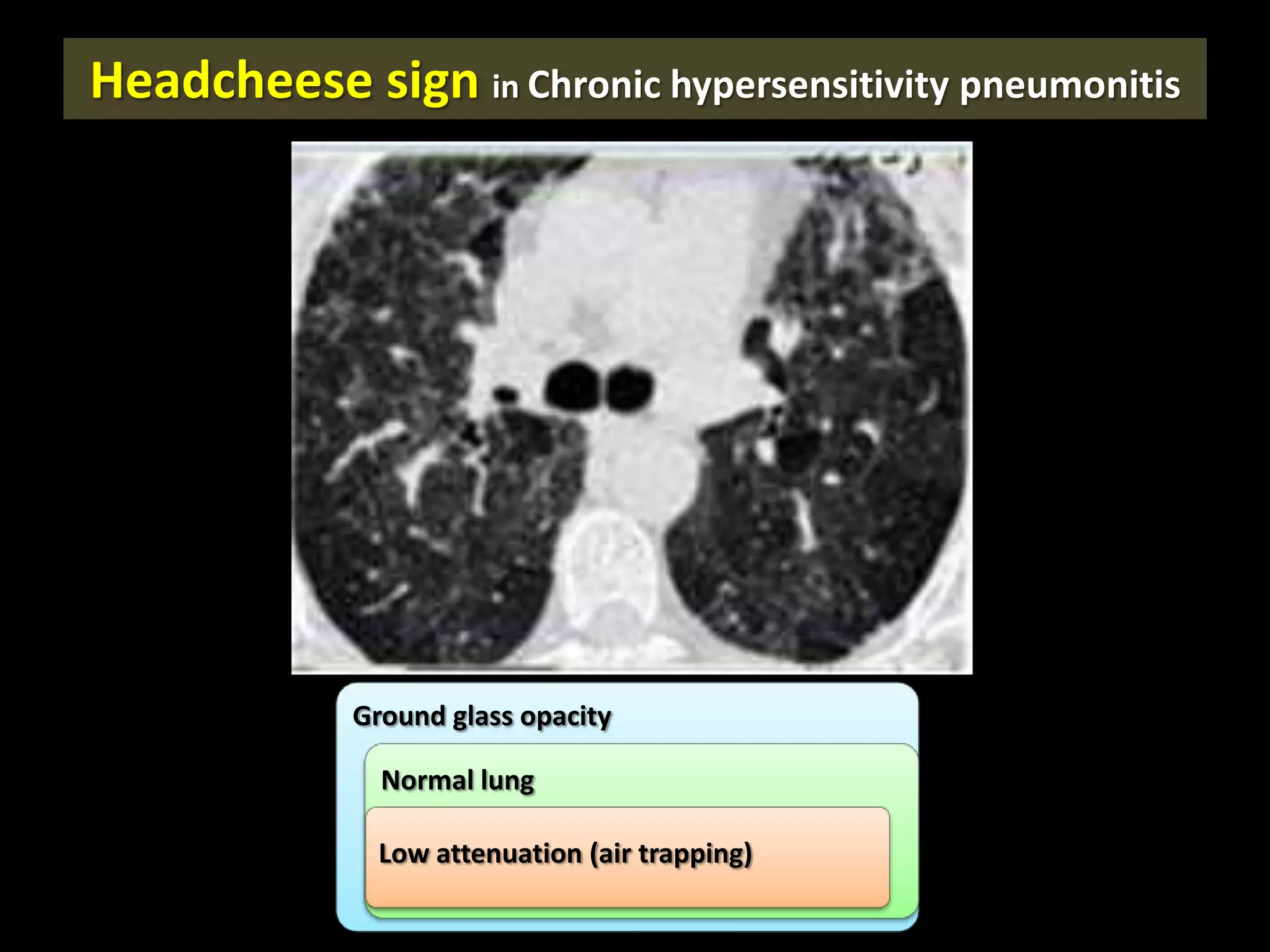 Figure 3 sign fleischner sign-fissure sign-headcheese sign-hilar ...