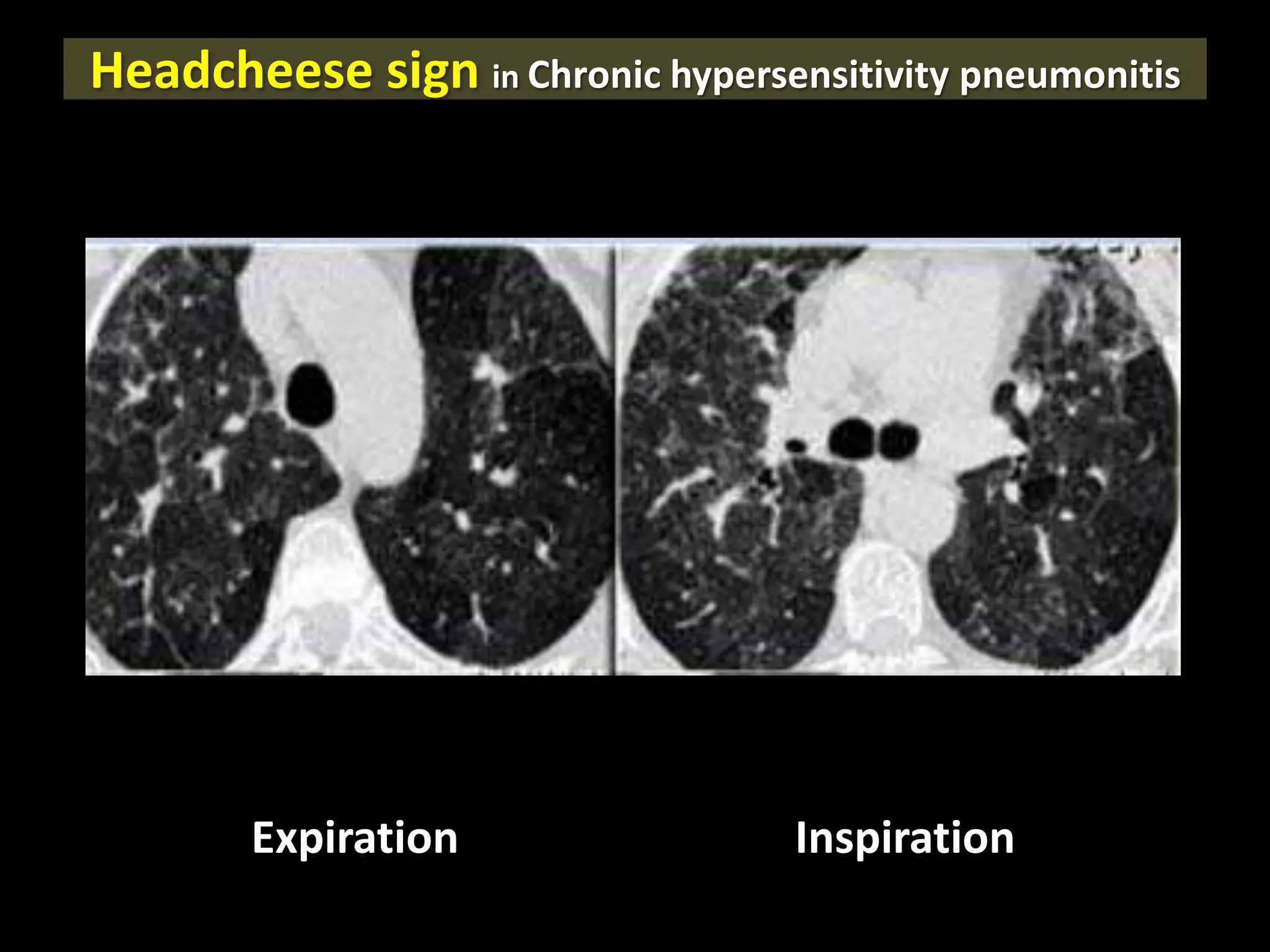 Figure 3 sign fleischner sign-fissure sign-headcheese sign-hilar ...