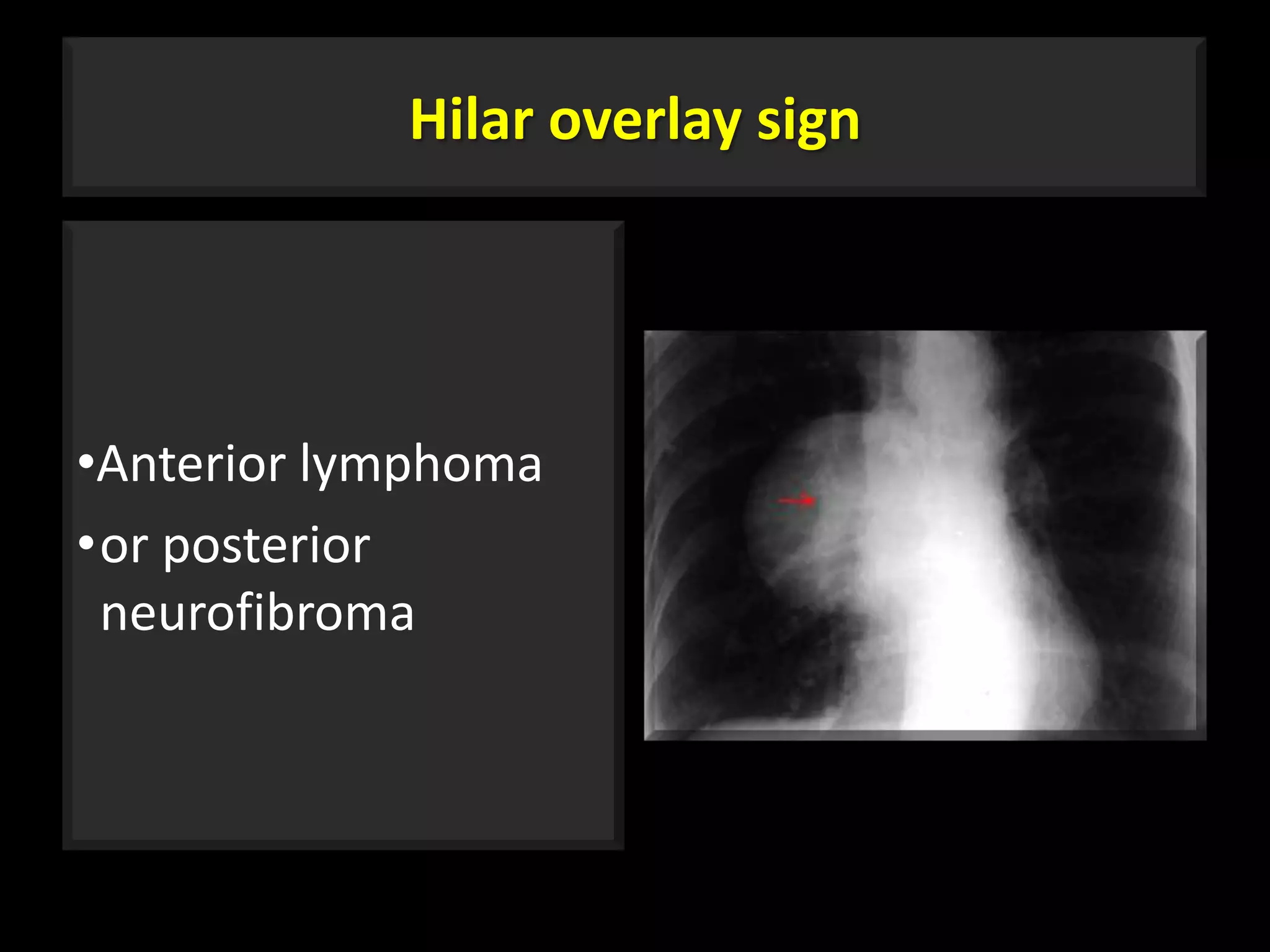 Figure 3 sign fleischner sign-fissure sign-headcheese sign-hilar ...