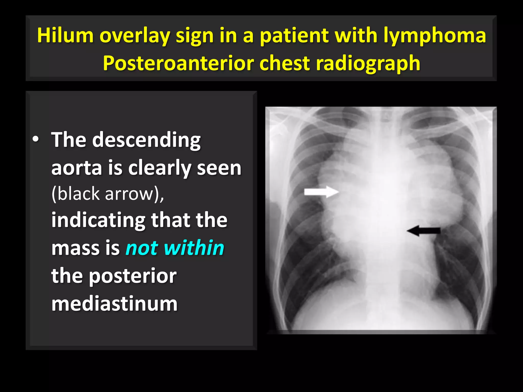 Figure 3 sign fleischner sign-fissure sign-headcheese sign-hilar ...