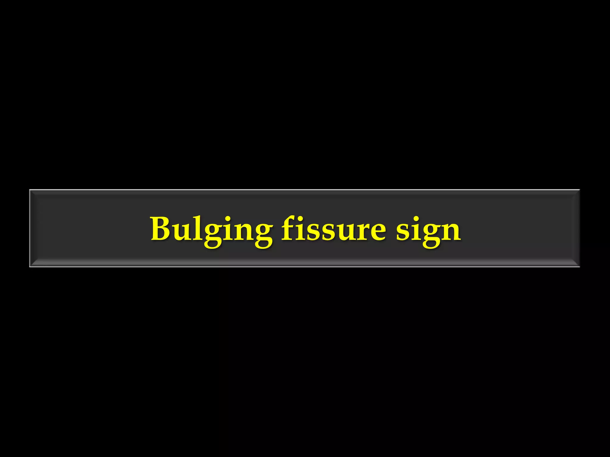 Figure 3 sign fleischner sign-fissure sign-headcheese sign-hilar ...