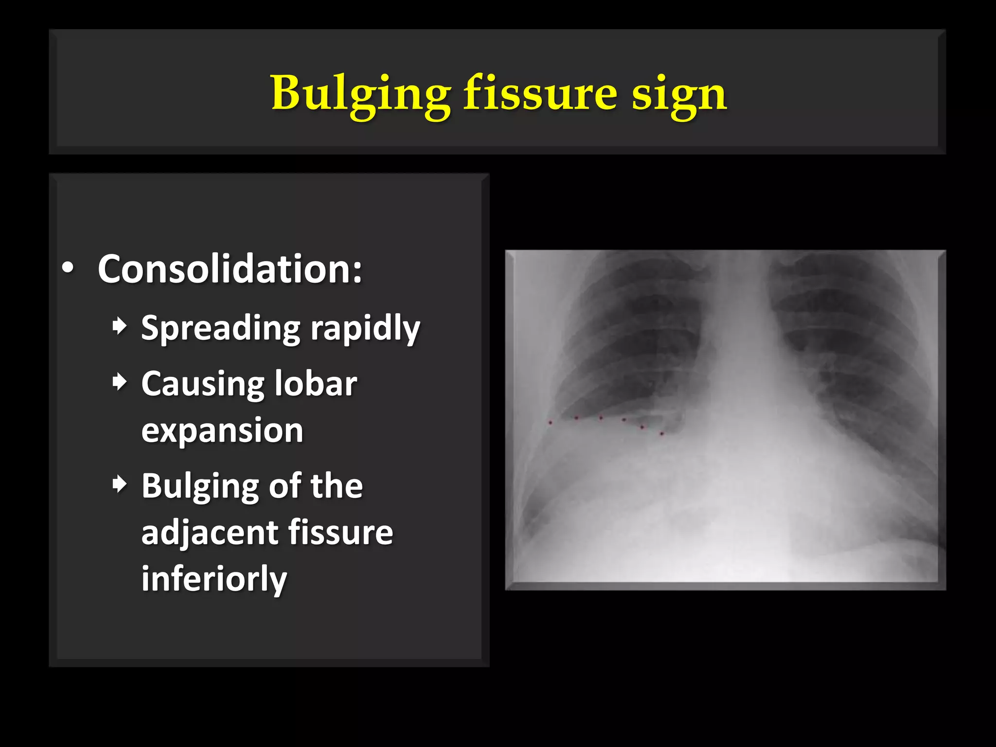 Bulging Fissure Sign Radiopaedia