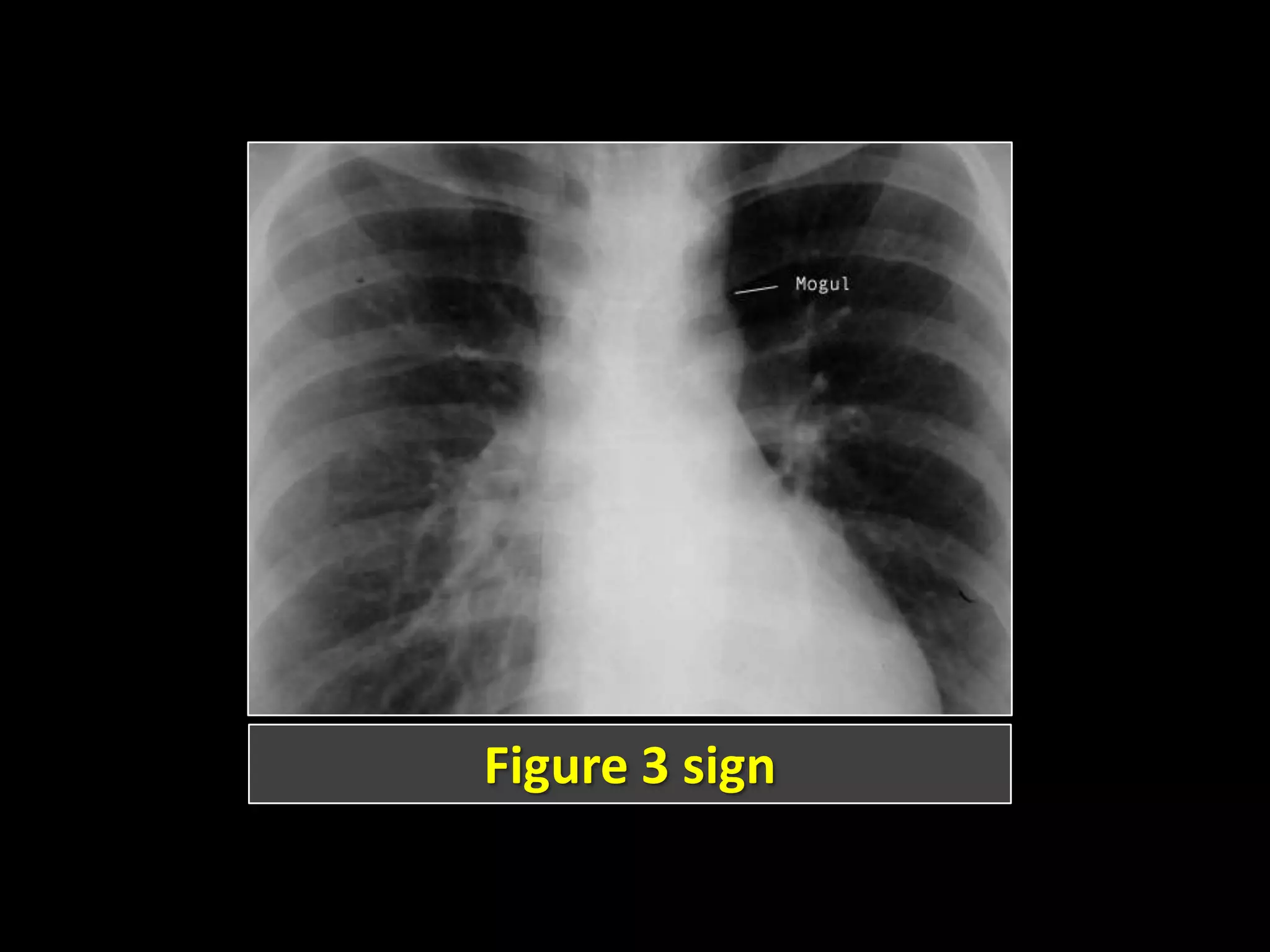 Figure 3 sign fleischner sign-fissure sign-headcheese sign-hilar ...