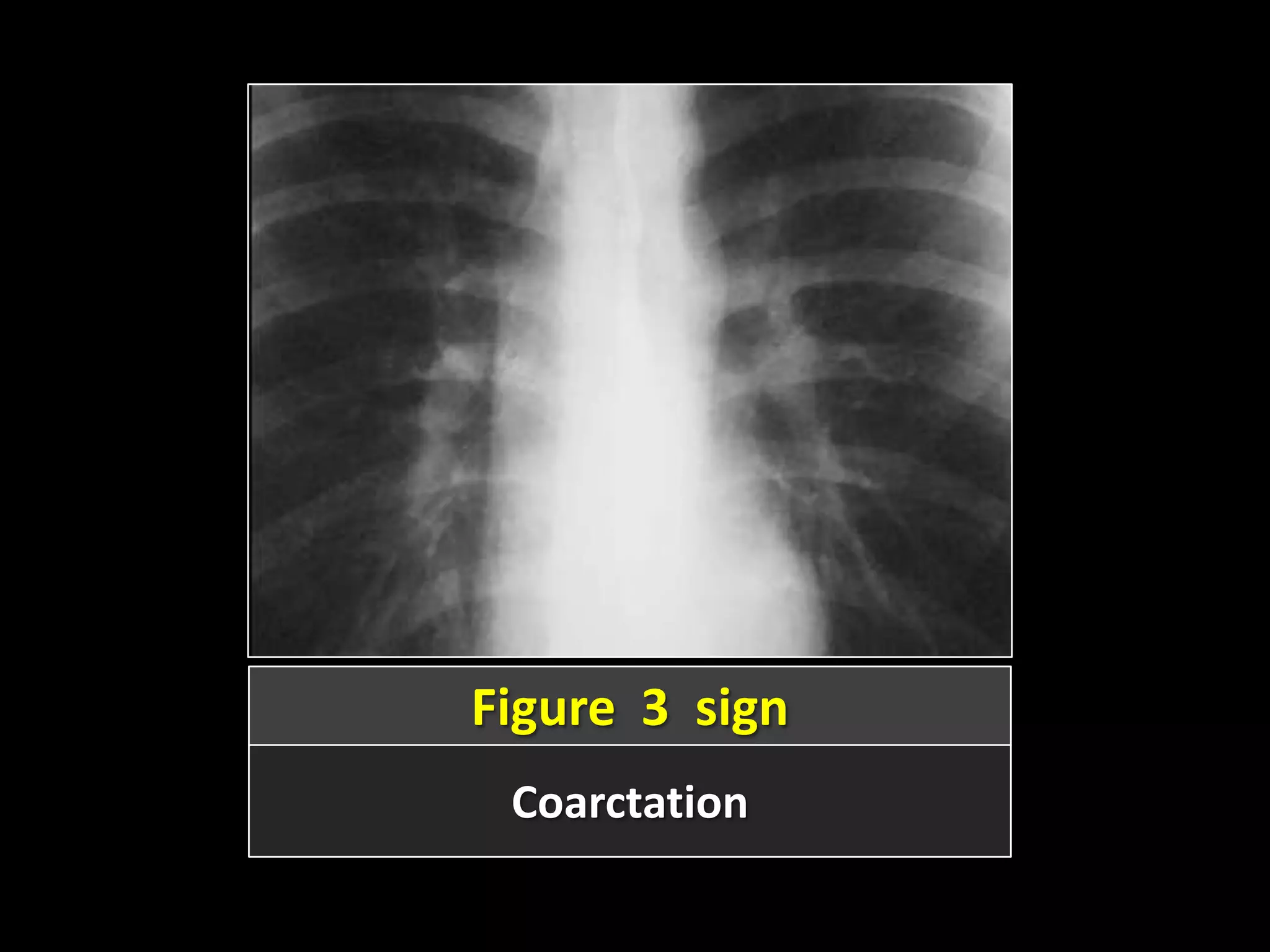 Figure 3 sign fleischner sign-fissure sign-headcheese sign-hilar ...