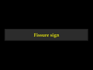 Figure 3 sign fleischner sign-fissure sign-headcheese sign-hilar ...
