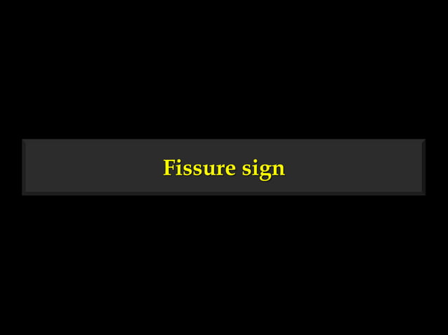 Figure 3 sign fleischner sign-fissure sign-headcheese sign-hilar ...