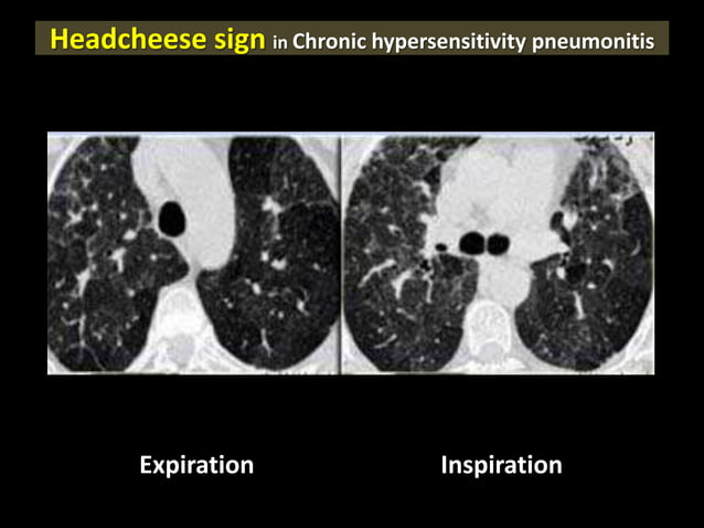 Figure 3 sign fleischner sign-fissure sign-headcheese sign-hilar ...
