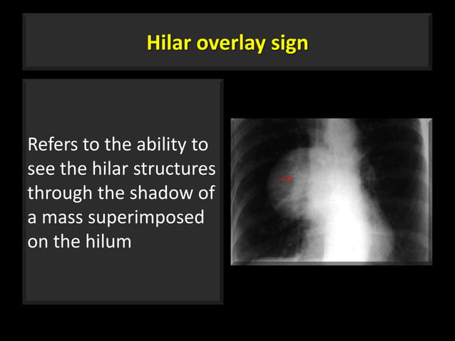 Figure 3 sign fleischner sign-fissure sign-headcheese sign-hilar ...