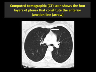 Figure 3 sign fleischner sign-fissure sign-headcheese sign-hilar ...